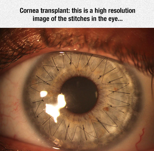 Eye Surgery Stitches.